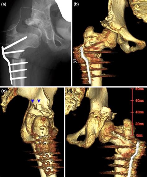 Postoperative Radiograph A And Three Dimensional Ct Scans B C D Download Scientific