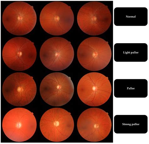 Evaluating Fundoscopy As A Screening Tool For Optic Nerve Atrophy In
