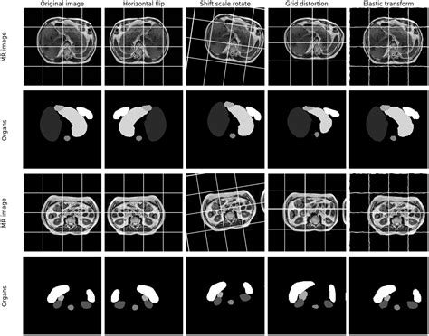 Frontiers Deep Learning Application For Abdominal Organs Segmentation On 035 T Mr Linac Images