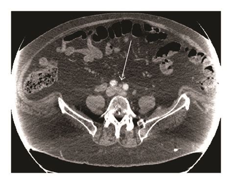 A Bladder Mass After Chemotherapy B Pelvic Lymphadenopathy After