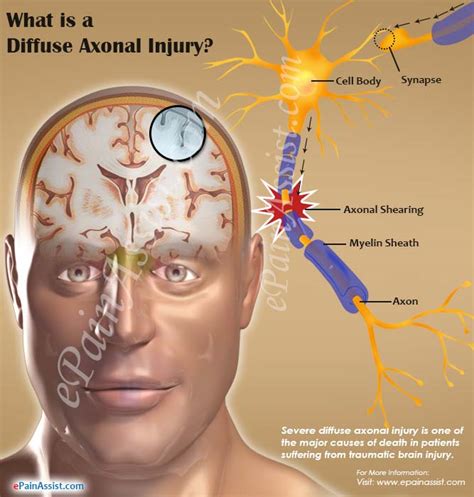 What Is Diffuse Axonal Injury And How Is It Treated