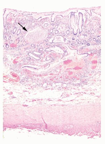 Ulcerative Colitis Abdominal Key