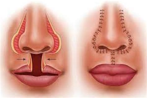 Lip Reconstruction Surgery In Hyderabad Akruti