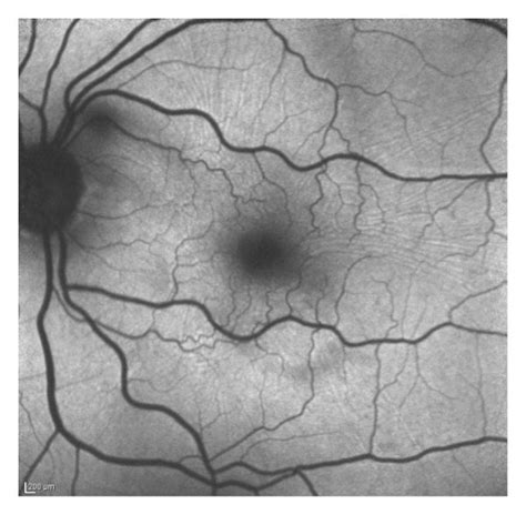 A Near Infrared SD OCT Horizontal Scan And B Corresponding AF Image Download Scientific