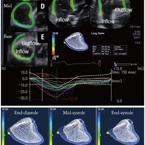 Right Ventricular 3 Dimensional Speckle Tracking Echocardi Ography Download Scientific Diagram