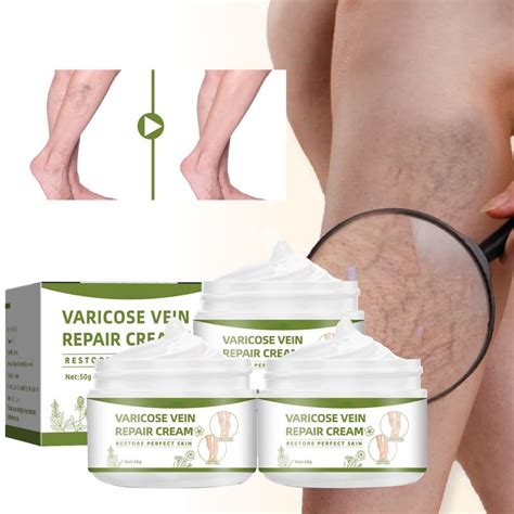 Varicose Veins Relief Creamvaricose Veins And Spider Vein Cream For Legs