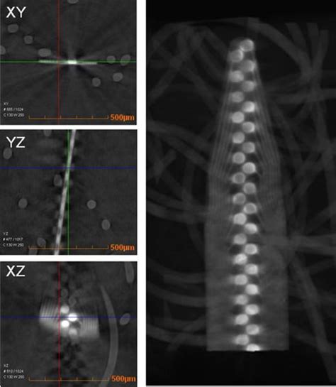 Enhanced X Ray Imaging For A Thin Film Cochlear Implant With Metal Artefacts Using Phase