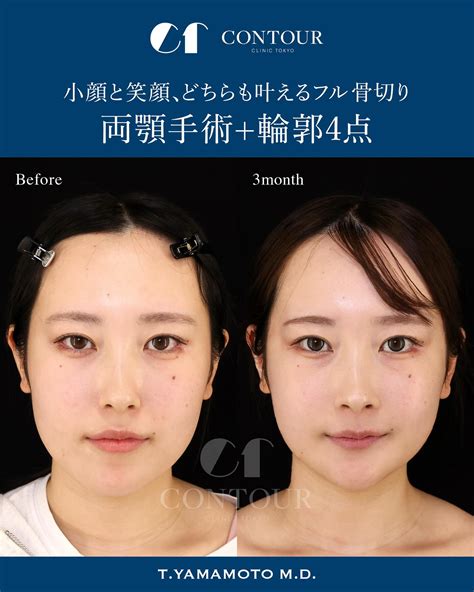 コントアクリニック東京美容外科 美容皮膚 審美歯科 コントアクリニック両顎手術 コントアクリニック輪郭4点 【両顎手術＋輪郭4点症例