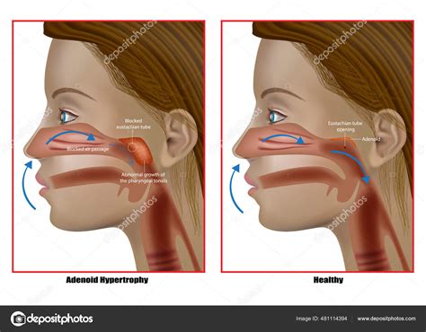 Adenoid Hypertrophy The Abnormal Growth Of The Pharyngeal Tonsils Adenoidectomy Eustachian