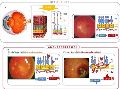 Disease Pathology TargetAMD