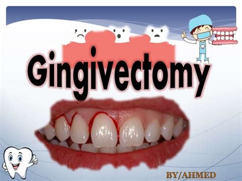 Gingivectomy Pptx