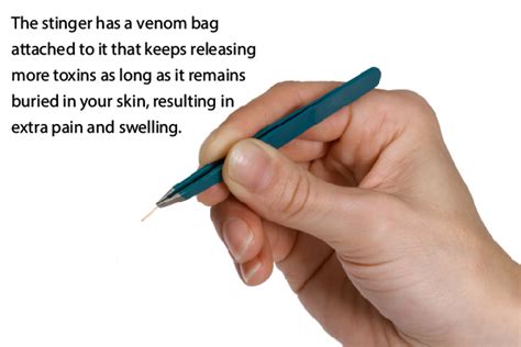 Wasp Stinger Stuck In Skin