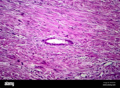 Uterine Fibroid Light Micrograph Lm Of A Section Through Tissue From