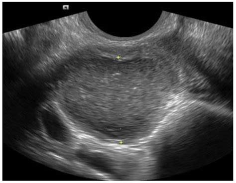Transvaginal Ultrasound In The Diagnosis And Assessment Of Endometriosis—an Overview How Why