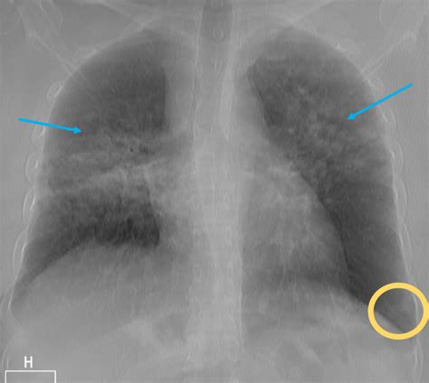 Sarcoidosis Thoracic Manifestations Pacs