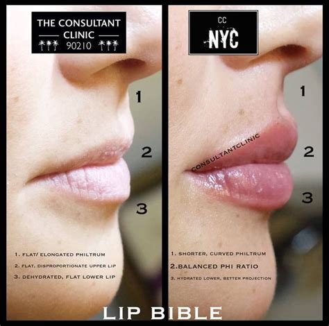 Pin By Jennifer Pappalardo On Lips Botox Lips Facial Fillers Lips Artofit