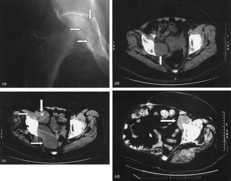 Sequential Imaging Of Our Case A Soft Tissue Mass In The Right Hip Download Scientific