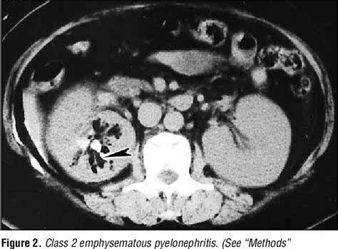 Figure 2 From Emphysematous Pyelonephritis Clinicoradiological Classification Management