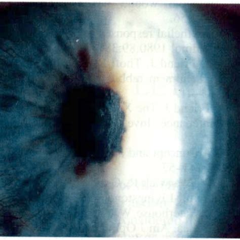 Schematic Epresentation Of The Vortex Keratopathy In The Patients Download Scientific