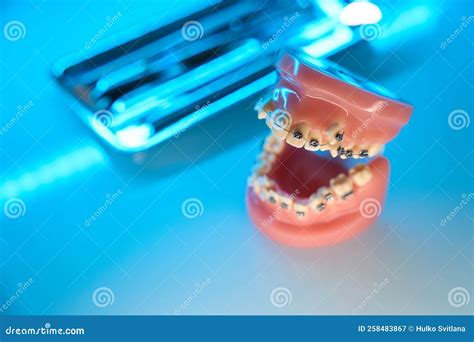 Open Jaw With Braces On Teeth Orthodontist Set Stock Image Image Of Medical Orthodontic
