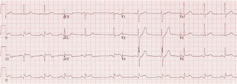 Inferior Stemi • Litfl • Ecg Library Diagnosis