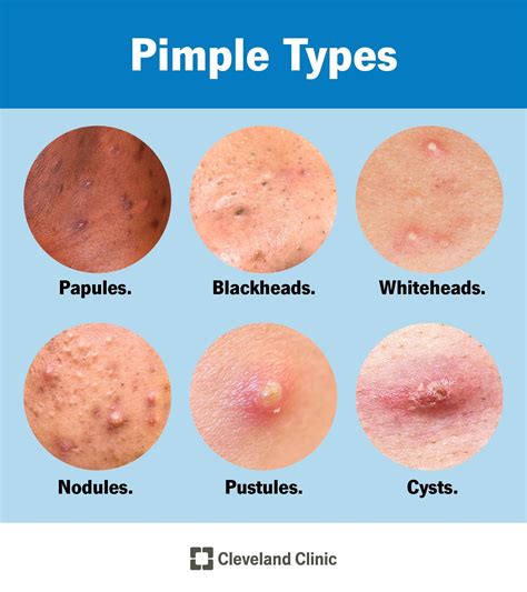 Pimples Causes Vs Acne Types Treatment Artofit