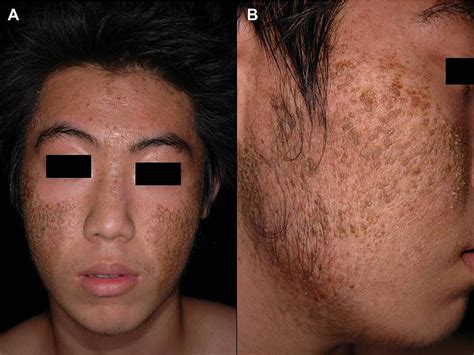 Hyperkeratosis Face