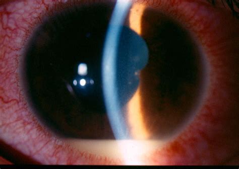 Hla B27 Anterior Uveitis Uveitis London