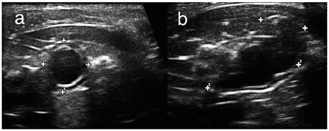 Ultrasound Image Of A Cyst Adjacent To The Antimesenteric Border Of