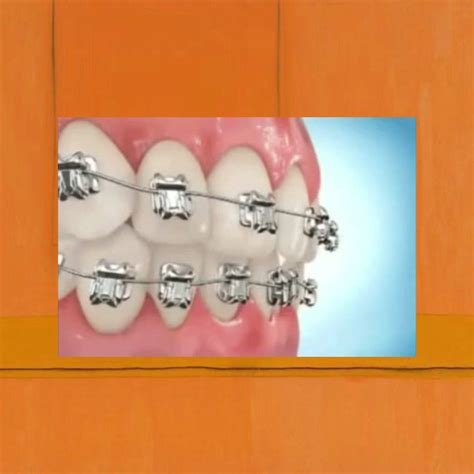 How Orthodontic Forces Causes Tooth Movement 💯 Orthodontist Dentist Dentistry