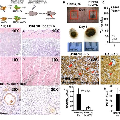 β Catenin Is Highly Expressed In Melanoma Associated Fibroblasts