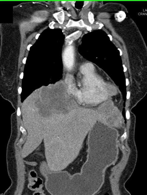 Carcinomatosis Of The Abdomen With Multiple Implants Gastrointestinal