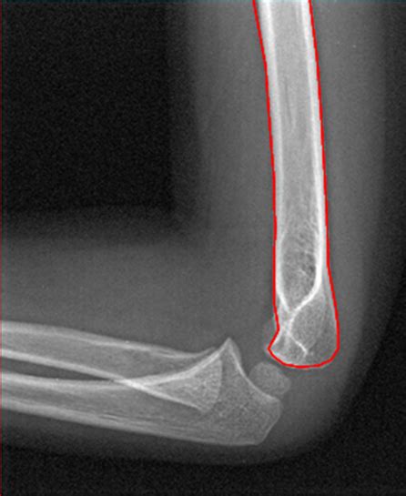 Lateral View Humerus