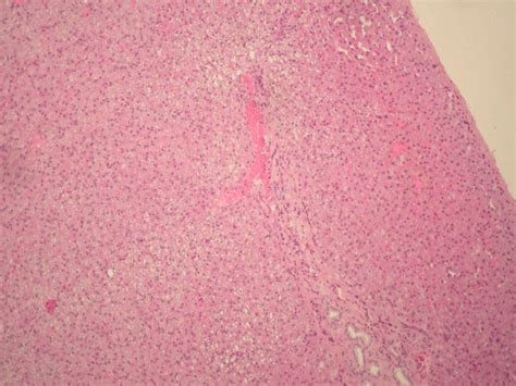 Photomicrograph Of The Ectopic Liver Tissue Hande X100 Showing Normal