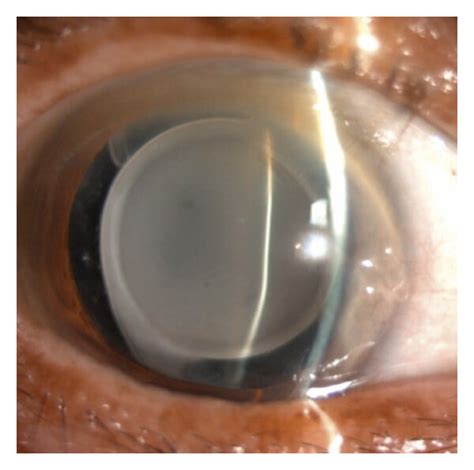 Photographs Of The Distinct Case Of Iol Opacification A E The Download Scientific Diagram