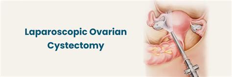 Laparoscopic Ovarian Cystectomy Procedure Guide