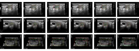 a swin transformer based model for thyroid nodule detection in ultrasound images scientific