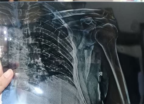 Scapular Fracture Medizzy