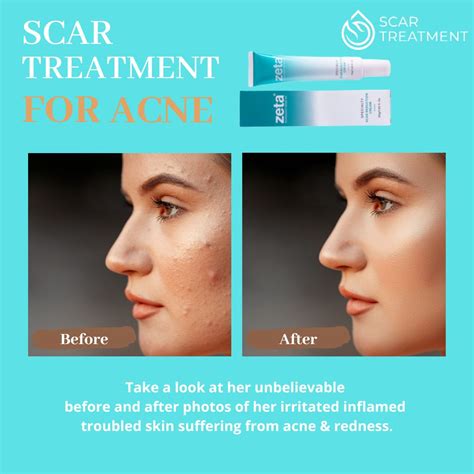 Scar Treatment On Linkedin Acnescars Acne Skincare