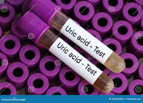 Uric Acid Test To Look For Abnormalities From Urine Urine Sample To