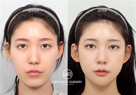 V Line Surgery In Korea Cost Care And Results Ab Plastic Surgery Korea