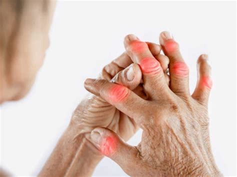 High Uric Acid Symptoms In Men S Top Unusual Signs Of High Uric Acid In Hands And Fingers