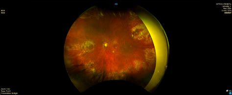 Silicone Oil Tamponade Widefield Fundus Image Download Scientific Diagram