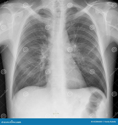 L Image Du Cancer Des Os Aux Rayons X Heju Blog Deco Diy Lifestyle