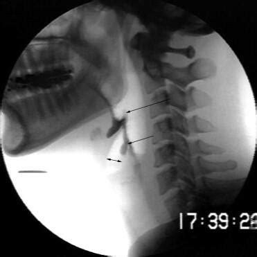 Laryngeal Vestibule