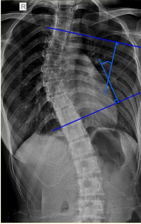 Adolescent Idiopathic Scoliosis Scoliosis Knowledge Hub