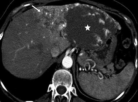 Cavernous Hemangioma Liver