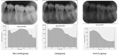 Typical Radiograph Images And Histograms Of The Second PSP In The Download Scientific Diagram