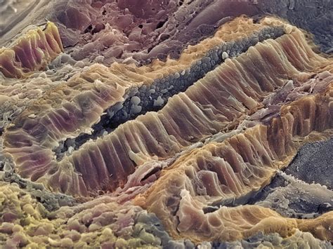 Ulcerative Colitis Sem Stock Image M130 0641 Science Photo Library