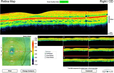 The Spectral Domain Optical Coherence Tomography Retinal Map Showing A Download Scientific